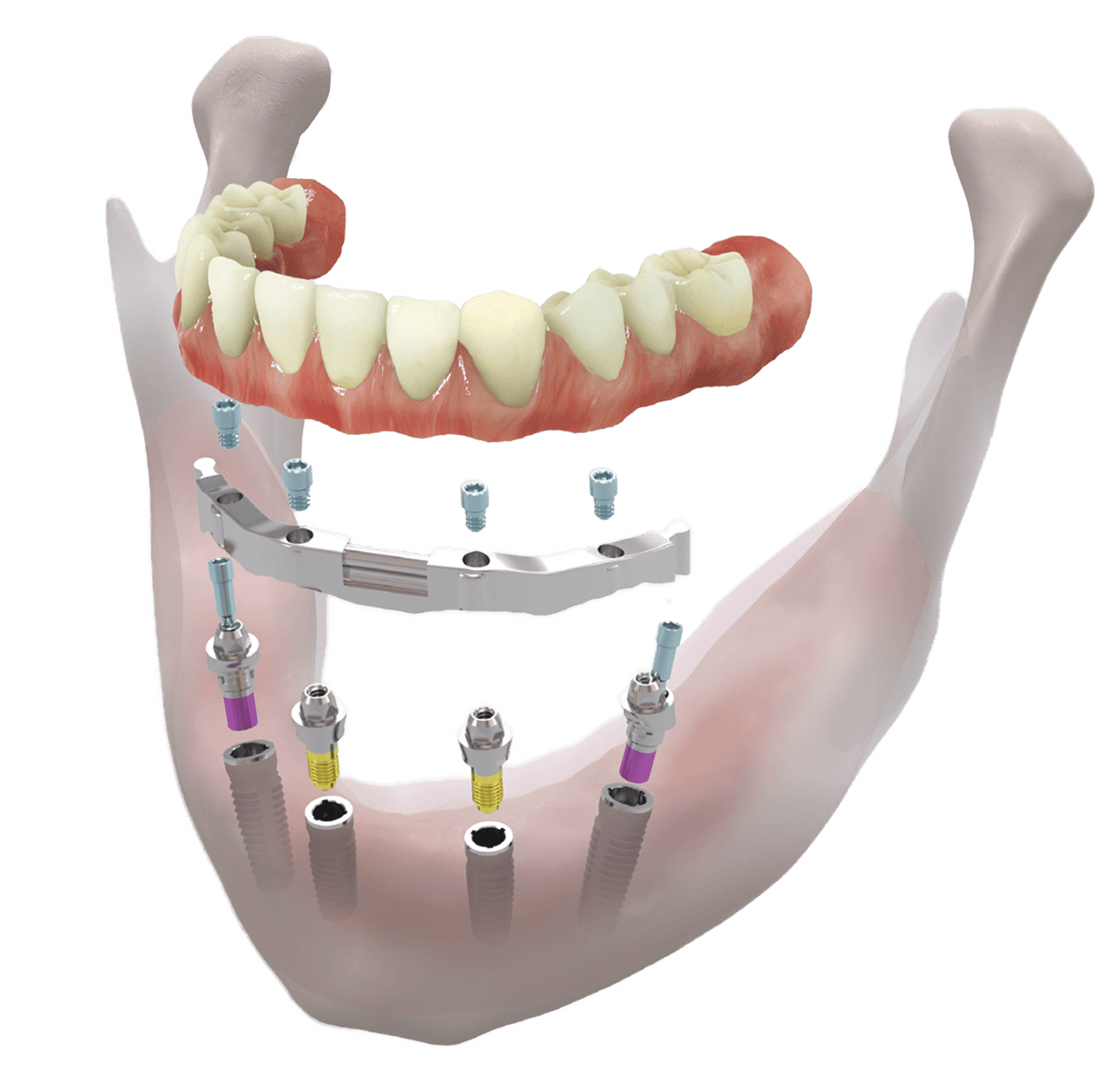 All On Four / All On Six Implantate | Avedent Zahnklinik in Istanbul ...