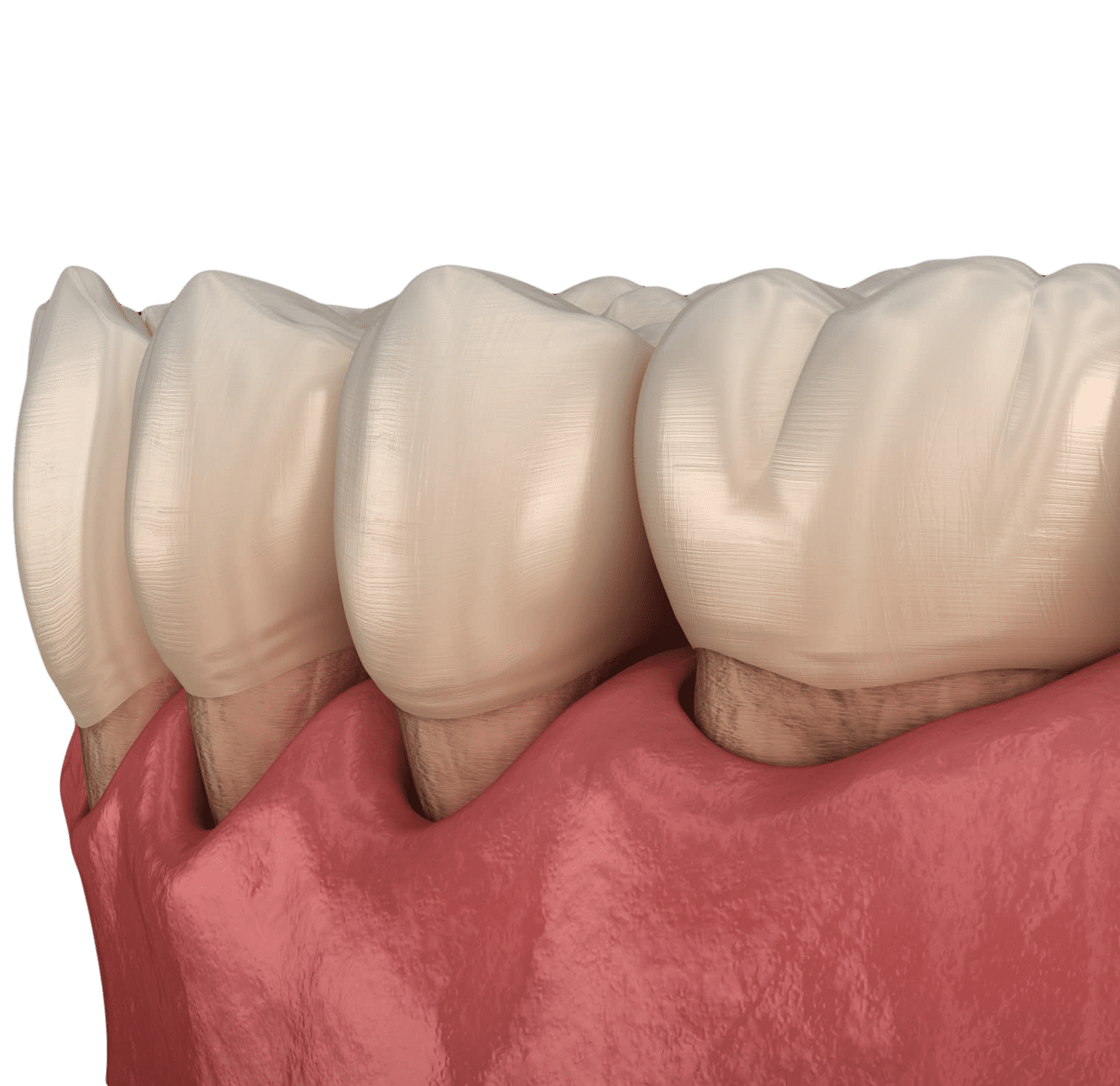 Gum Recession Treatments | Avedent Turkey Dental Clinic