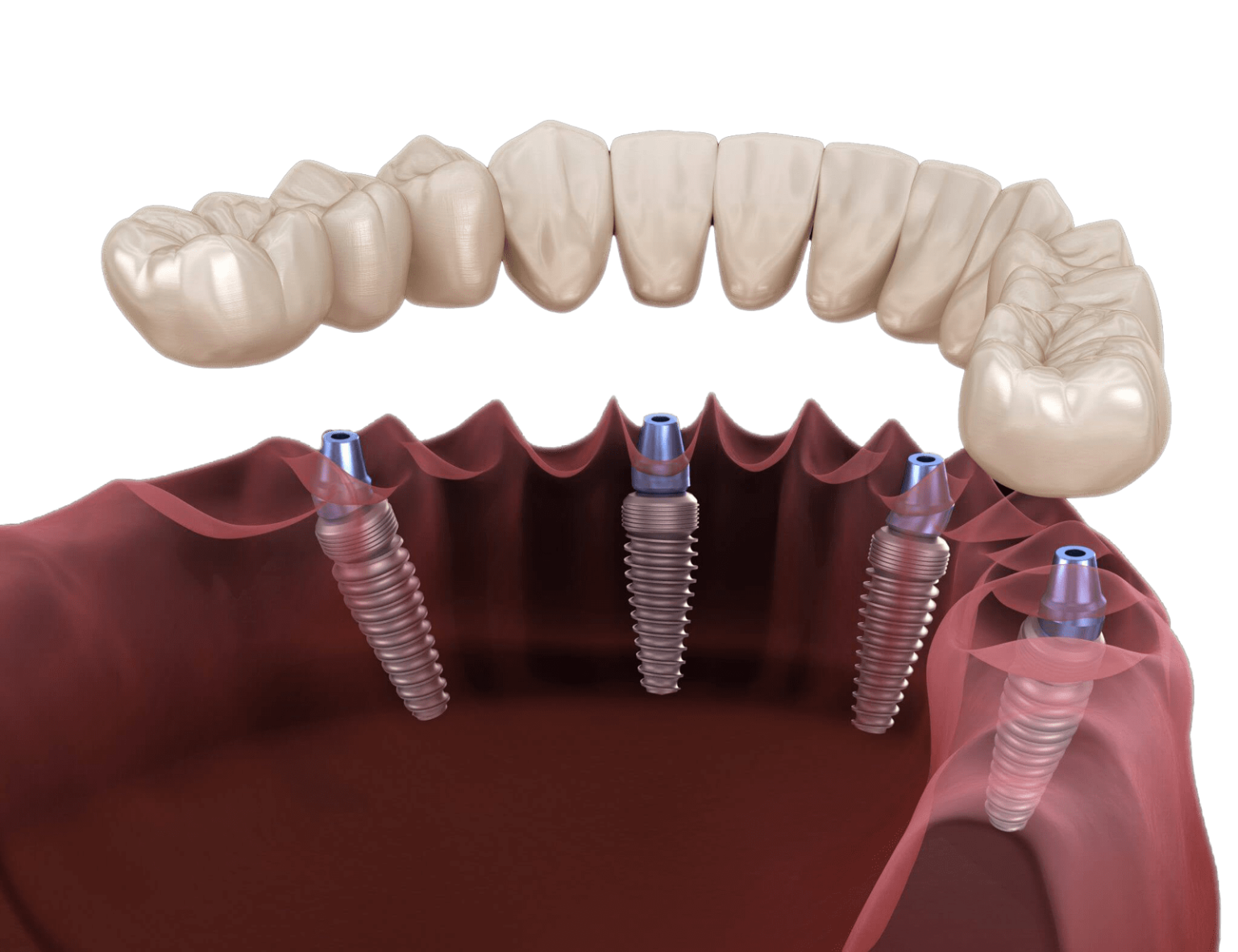 All On Four Six Dental Implants Istanbul,Turkey Costs, Reviews