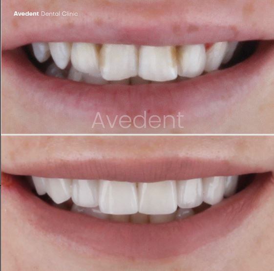Smile Makeover in Turkey | 5 Reason To Choose Avedent Turkey
