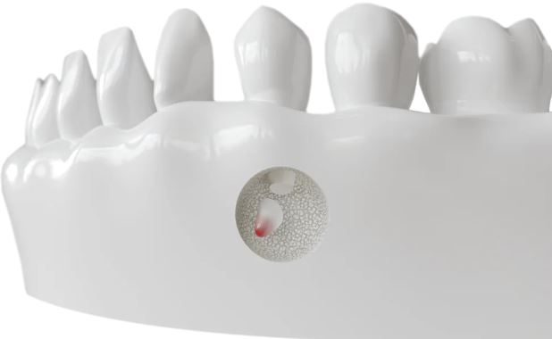 What is Apical Root Resection Surgery and Treatment? in Turkey