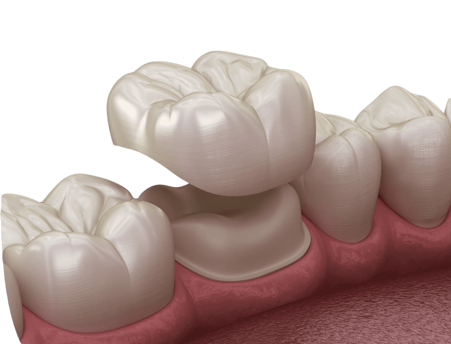 Dental inlays and onlays restorations - dental treatment | Avedent
