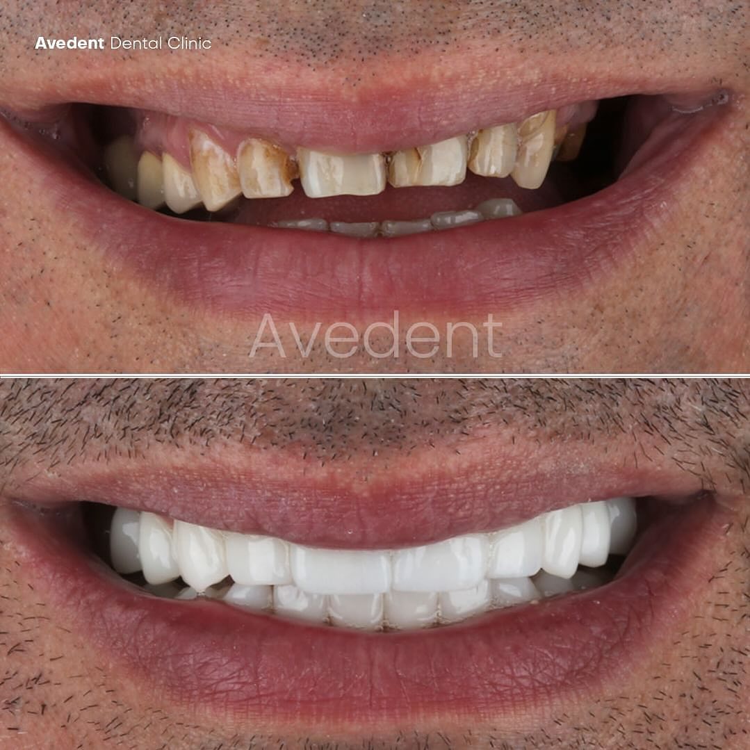 Turkey Teeth in Istanbul: Testimonials & Before and After Photos