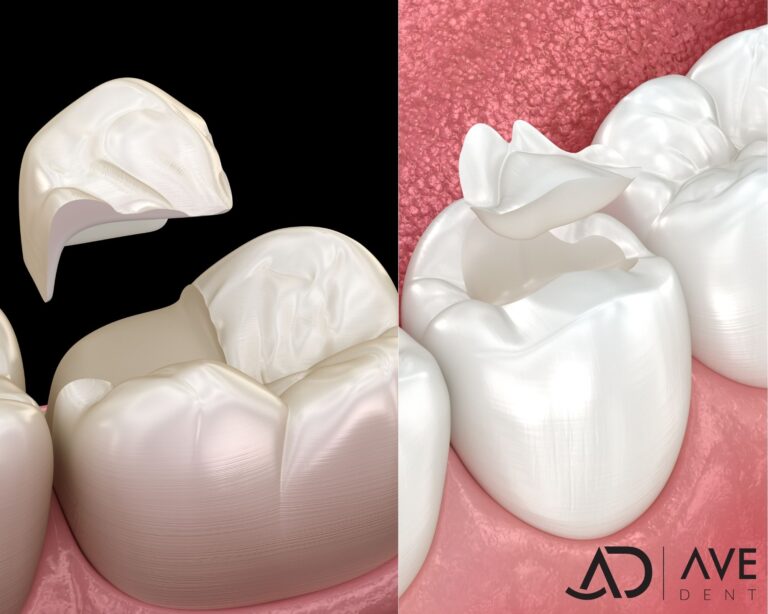 Dental inlays and onlays restorations - dental treatment | Avedent