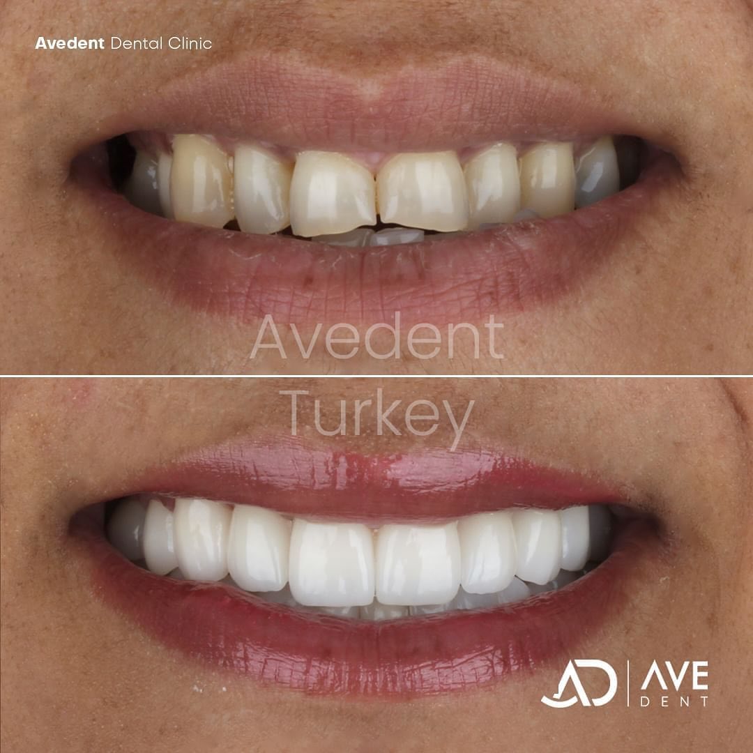 Turkey Teeth in Istanbul: Testimonials & Before and After Photos