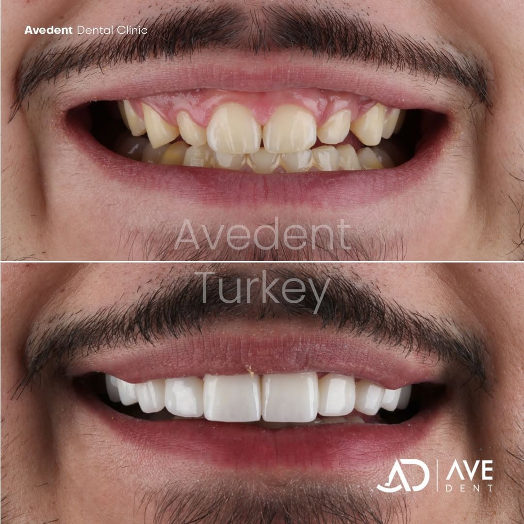 Turkey Teeth in Istanbul: Testimonials & Before and After Photos
