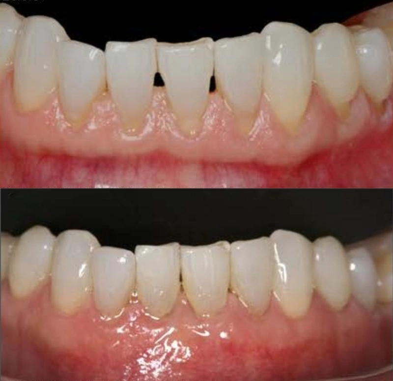 Gum recession / Gum graft surgery, Periodontal surgery in turkey