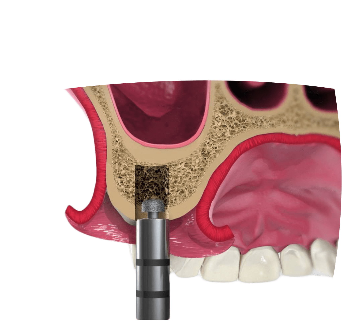 Sinus lift treatment & surgery for dental implant in Turkey istanbul