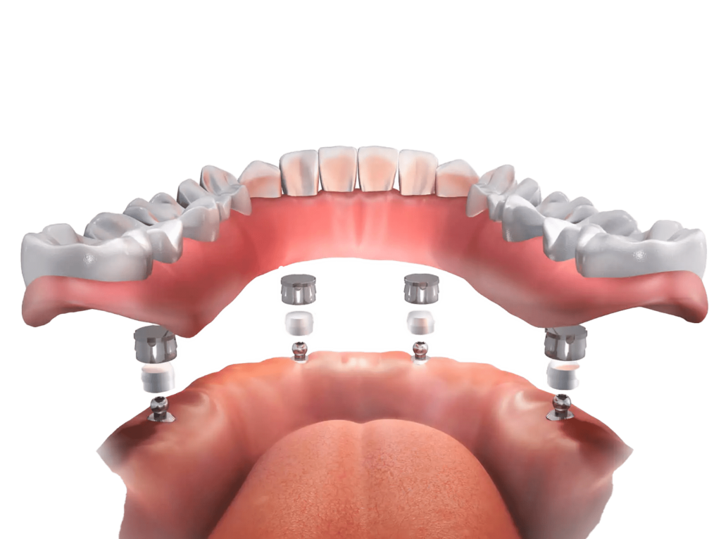 Bir Günde İmplant Diş İstanbul-Bir Günde İmplant Tedavi Fiyatları