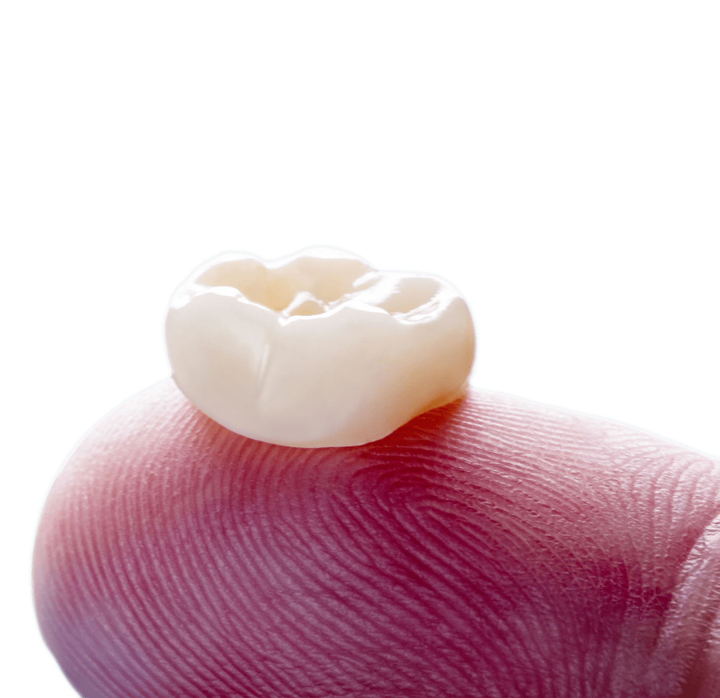 İnlay ve Onlay Dolgu Nedir? İstanbul Fiyatları-Farkları? | Avedent